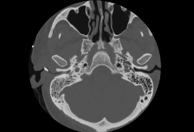 Foreign Bodies in the Head and Airways