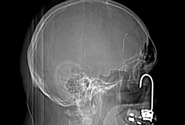 Foreign Bodies in the Head and Airways