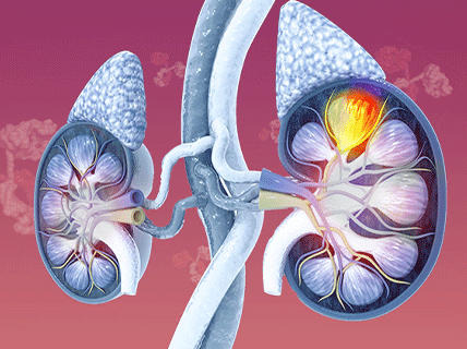 Nefropatia da IgA, proteinuria elevata anche con le terapie