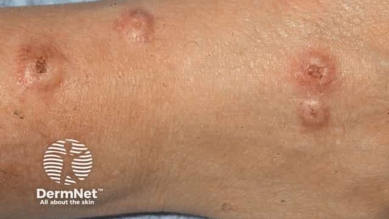 Vixarelimab Safe and Effective in Prurigo Nodularis
