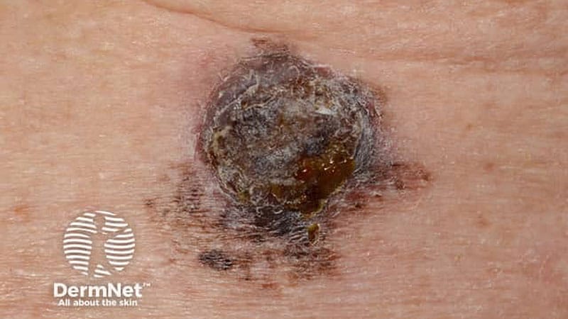 Study Identifies Factors Linked to Early Melanoma Recurrence