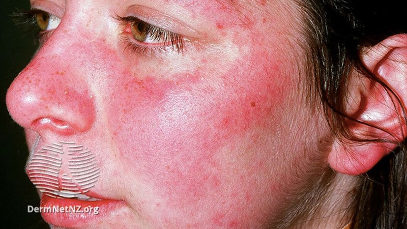 Iberdomide Promising for Cutaneous Lupus in Phase 2 Study