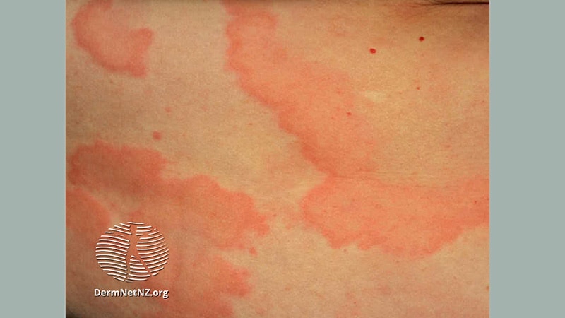 Remibrutinib for CSU Shows Sustained Efficacy at 1 Year