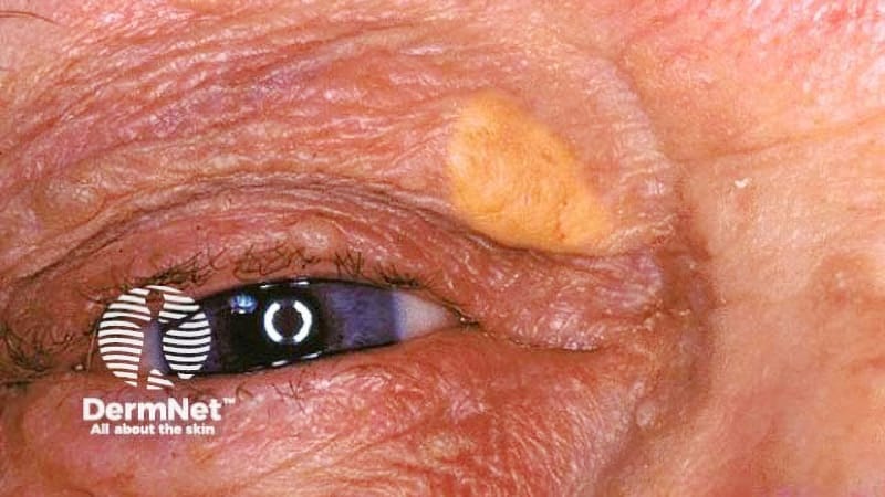 Xanthelasma Palpebrarum Xanthelesmia || Xanthoma || Cholestrol Deposit