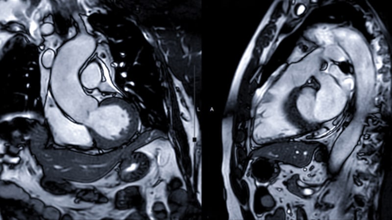 Stress CMR Imaging Alters Angina Diagnosis, Management