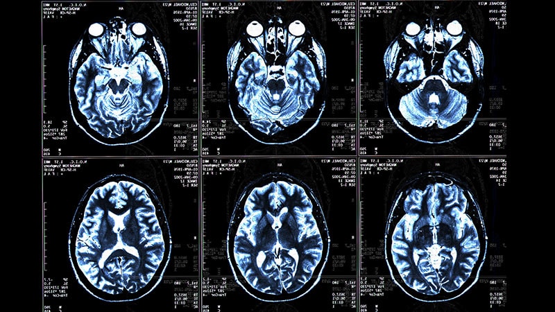 Novel AI Tool Accurately Tracks Efficacy of MS Treatments