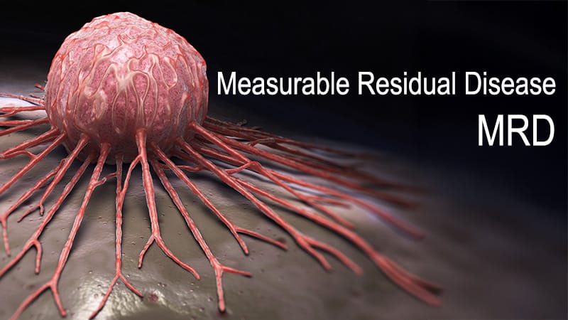 Multiple Myeloma | Medscape