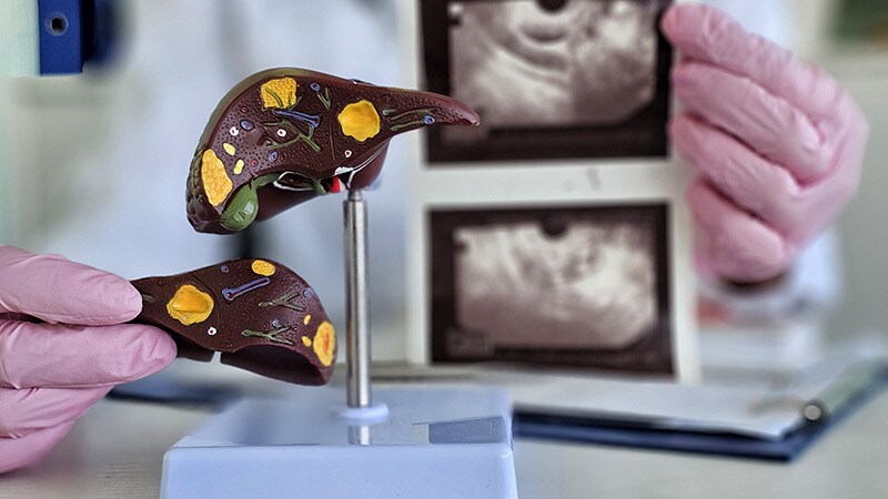 Novel Lipogenesis Inhibitor Combo Effective Against MASH