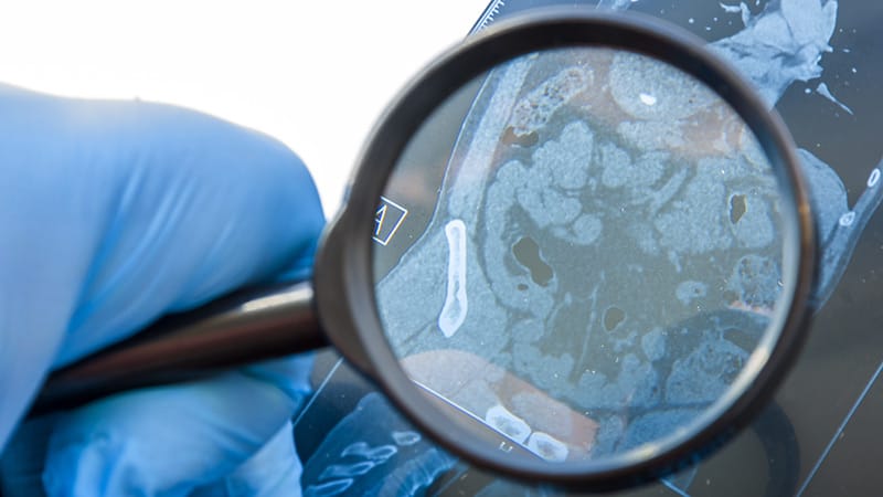 Rapid Review Quiz: Diverticulitis