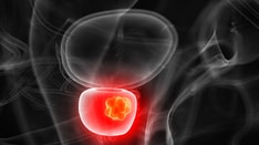 Enzalutamide Extends Survival in High-Risk Prostate Cancer