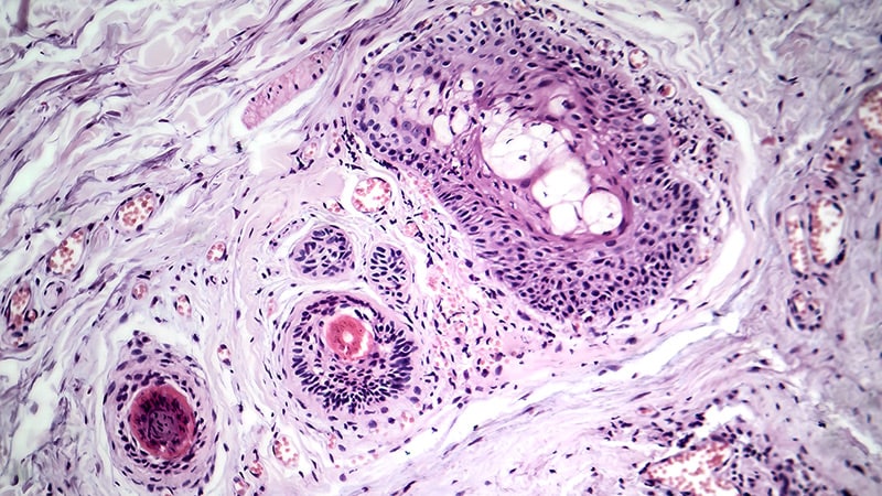 French Study Shows Distinct Features of Anogenital BCCs