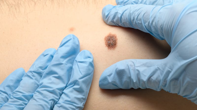 Test genomici per la prevenzione del melanoma