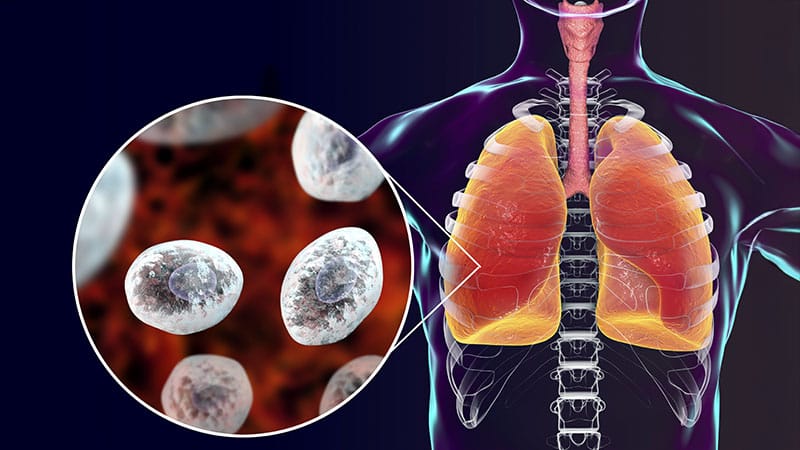 Do Steroids Help in HIV-Negative Pneumocystis Pneumonia?