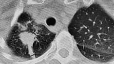 Some Smokers Had Delayed LC Risk, When to Rescreen Debated