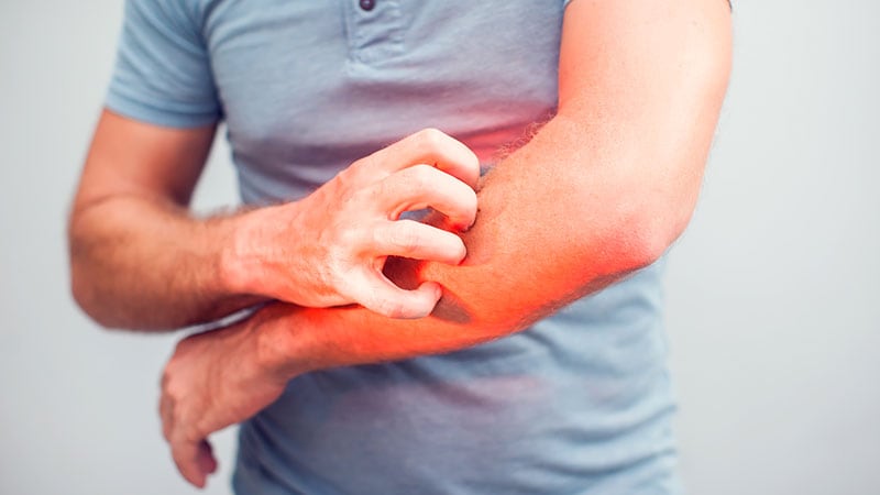 Pruritus Exhausts Primary Sclerosing Cholangitis Patients