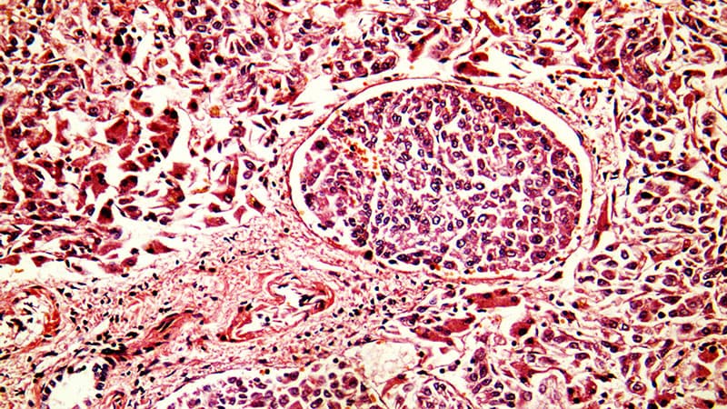 Fast Five Quiz: Presentation & Diagnostic Approach in HCC