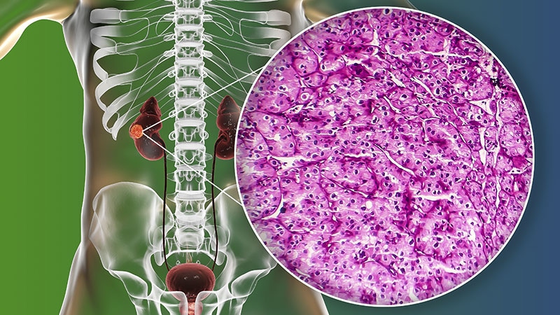 Fast Five Quiz: Management of RCC