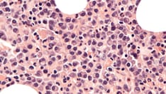 FDA Approves New Drug Combo for RR Multiple Myeloma