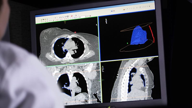 Dépistage ciblé du cancer du poumon : l'expérimentation débute dans 5 ...