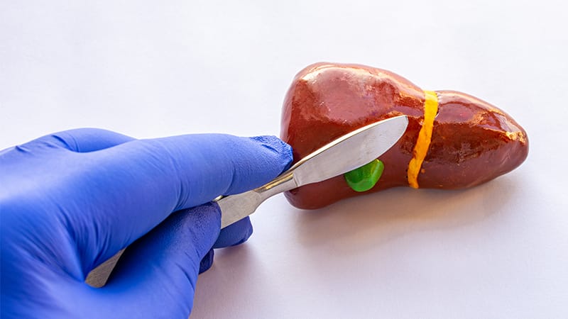 Subtotal Cholecystectomy Often Chosen Out of ‘Habit or Fear’