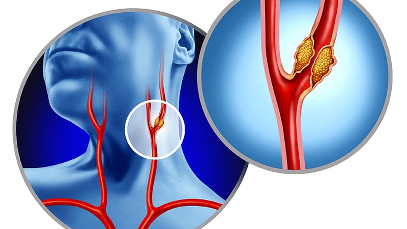 Carotid Revascularization May Lower Seizure Risk in Stenosis