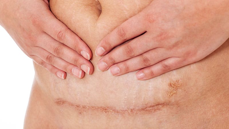 Cesarean Surgical Complications Linked to Readmission Risk
