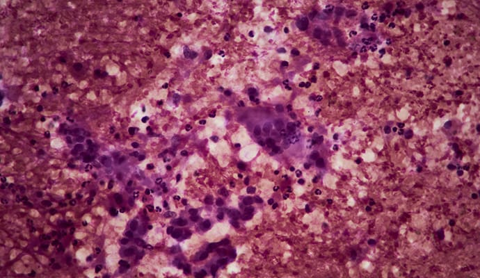 Résultats spectaculaires du daraxonrasib dans le cancer du pancréas