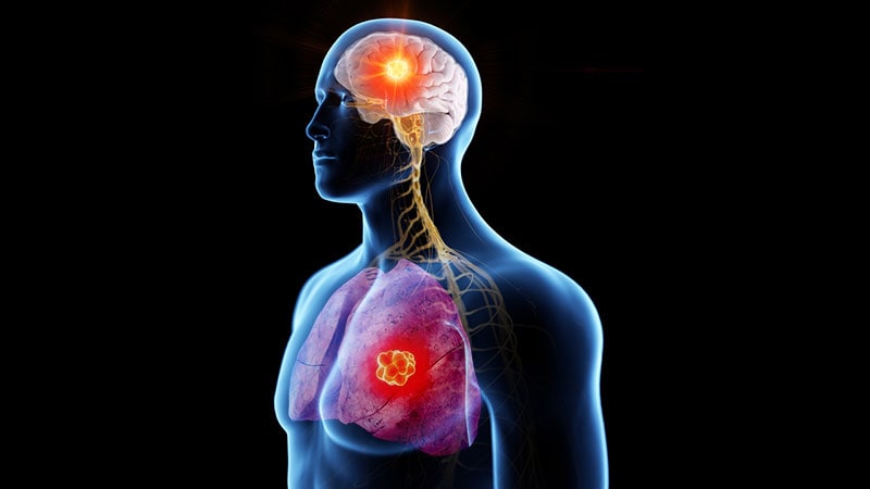 Conexão 'astuta' entre cérebro e câncer de pulmão surpreende pesquisadores