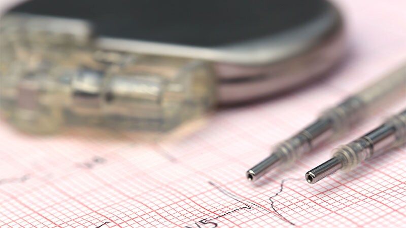 Mechanical Aspiration Aids Lead Extraction in Endocarditis