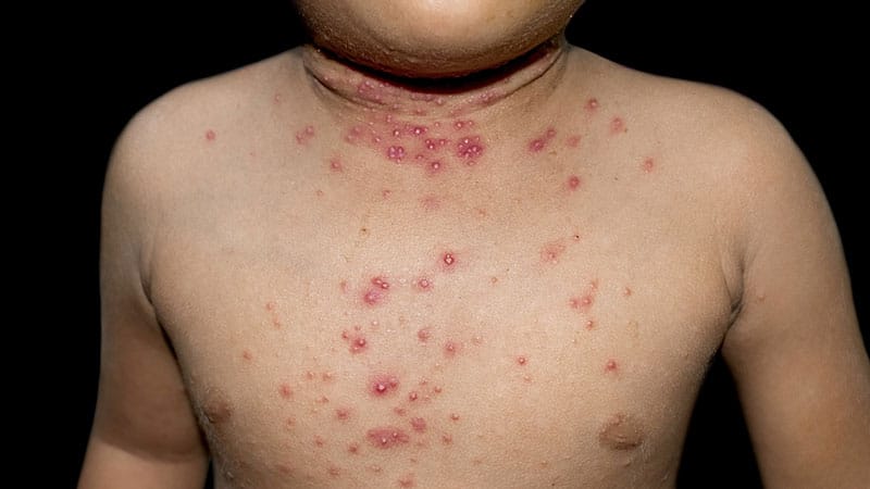 Off-Label Rxs: Thinking Out of the Box for Skin Diseases