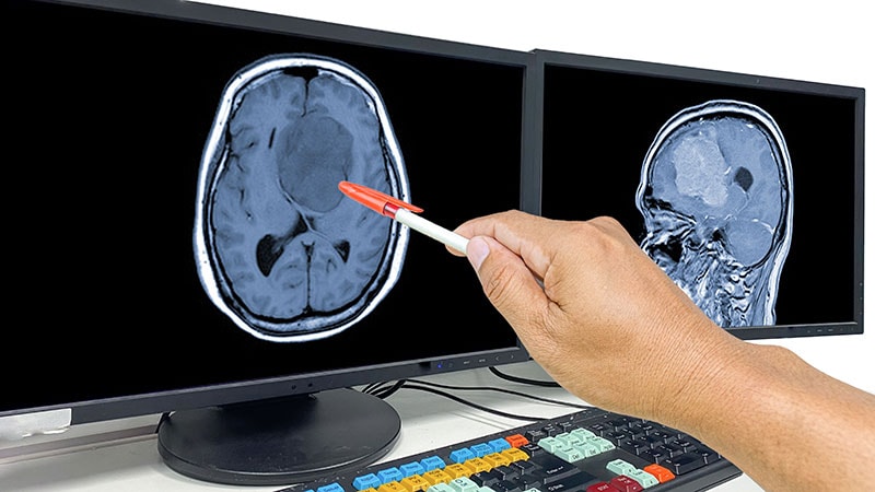 PPI Use Linked to Poor Survival Outcomes in Glioblastoma