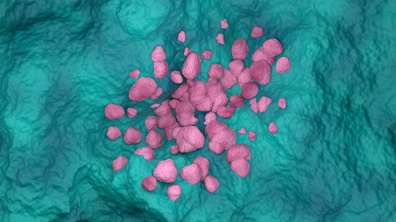 Trial Supports Ivonescimab and Chemo for NSCLC Survival
