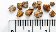 Hidden Bacteria Found in Common Kidney Stones