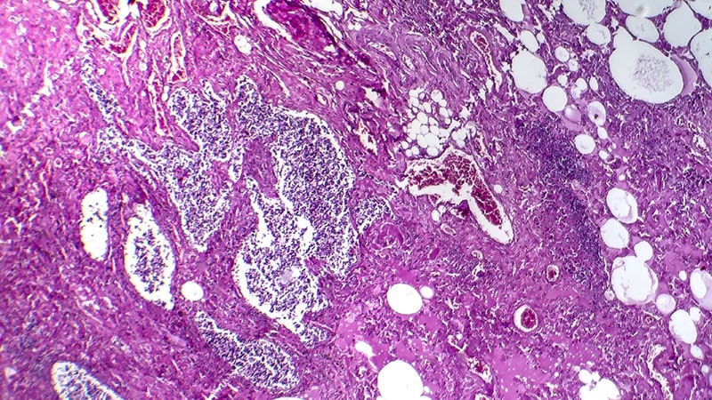 Alectinib And Pembrolizumab For Non Small Cell Lung Cancers