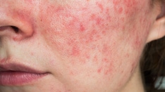 How to Calm Rosacea-Related Facial Erythema, Flushing