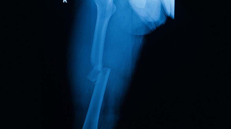 CGRP Mab for Migraine Linked to Fracture Risk