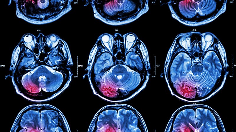 Stroke Burden Surges Among US Adults