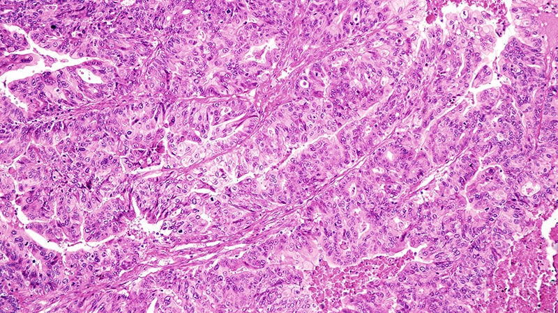 High-grade Serous Carcinomas Follow Missed Salpingectomies