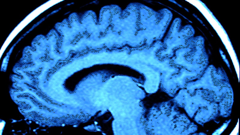 CV Risk Linked to Earlier Gray Matter Volume Loss in Men