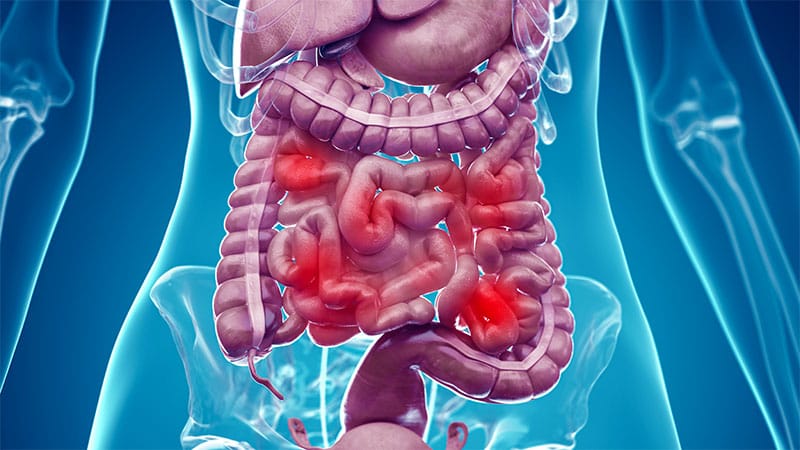 Infections Common in IBD, Rates Vary by Treatment