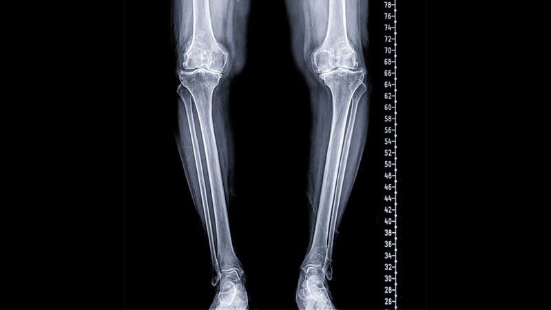 HTO May Slow Knee OA Progression in Bowlegged Patients