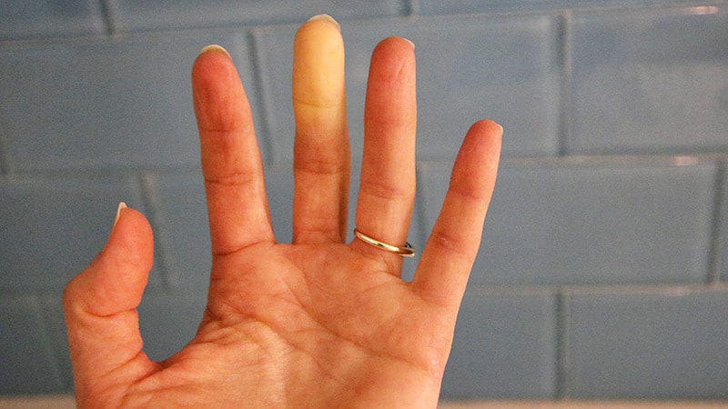 Raynaud Phenomenon Tied to Elevated Cardiovascular Risk