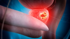 Imaging Falls Short for Staging Prostate Cancer