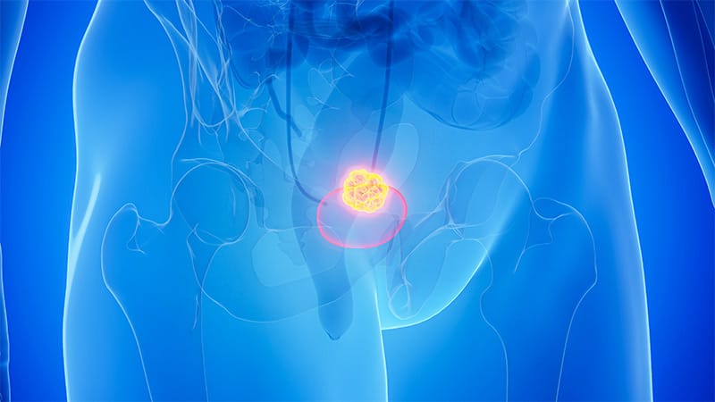 ctDNA-Guided Therapy Improves Survival in Bladder Cancer