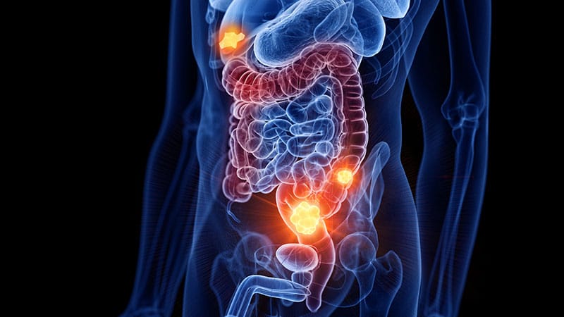 Biosimilars Tip NICE Decision on Bowel Cancer Drug