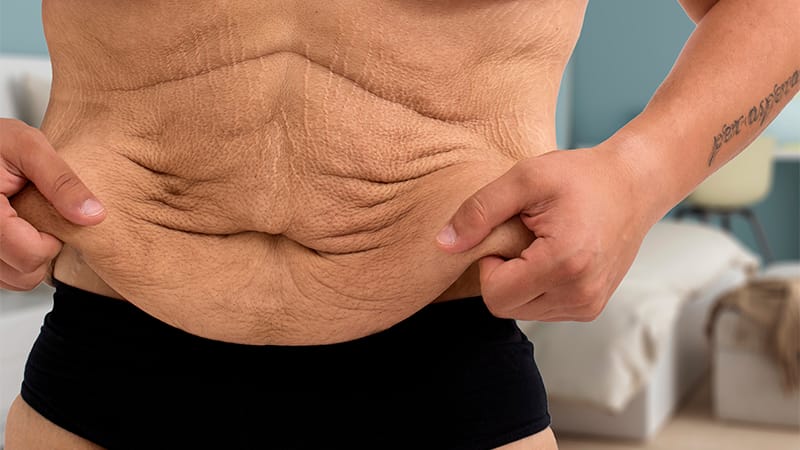 Explaining Skin Laxity After Drastic GLP-1 Weight Loss