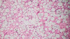 Abemaciclib Slows Progression of Advanced Liposarcoma