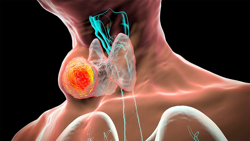 Thyroglobulin Levels May Predict Thyroid Cancer Recurrence