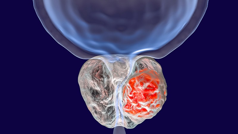 Caso clínico: Bezoar rectal relacionado con la ingestión de semillas de ...