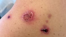 Pemphigus: Rituximab Shows Lower Cancer Risk Than Other Txs